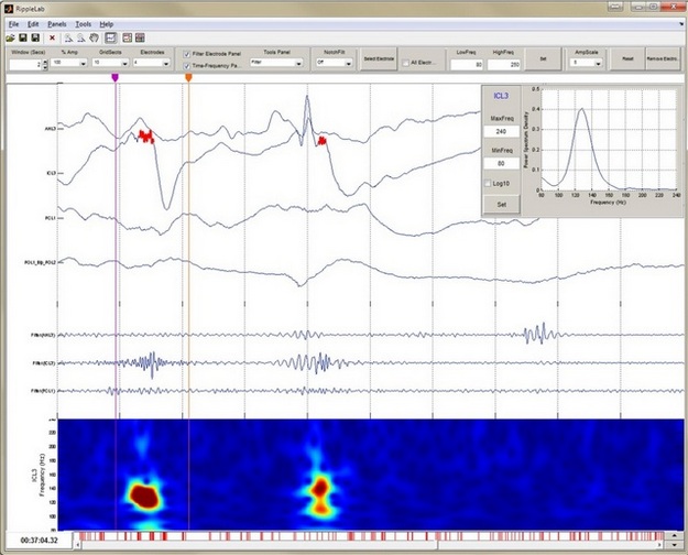 RIPPLELAB: A visual tool for HFO analysis - Miguel Navarrete, PhD